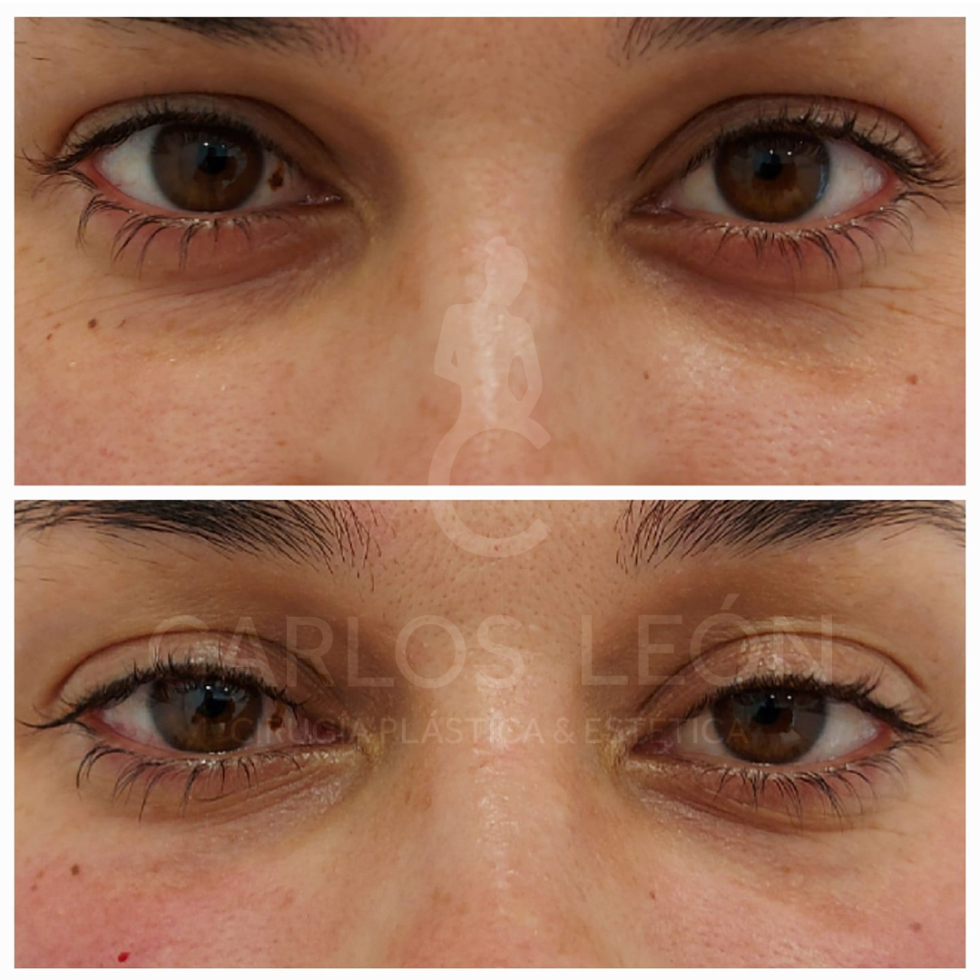 Galería antes y después de un Relleno de ojeras Galería antes y después de un Relleno de ojeras